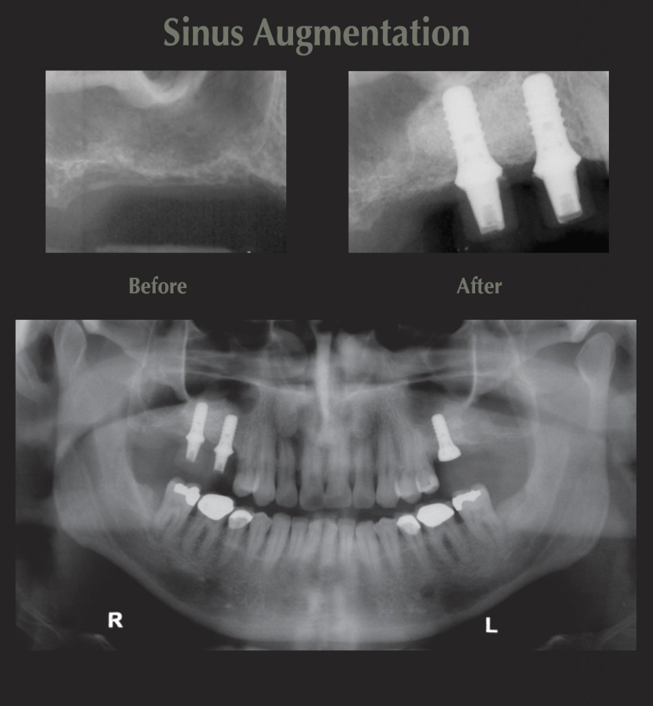 Ridge/Sinus Augmentation - Tymkiw Periodontics - Kelowna Periodontist ...