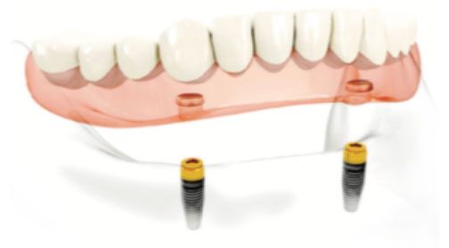 Teeth in a Day | Implant OverDenture | Periodontist Kelowna and Vernon