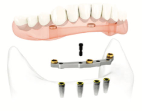 Teeth in a Day | Implant OverDenture | Periodontist Kelowna and Vernon